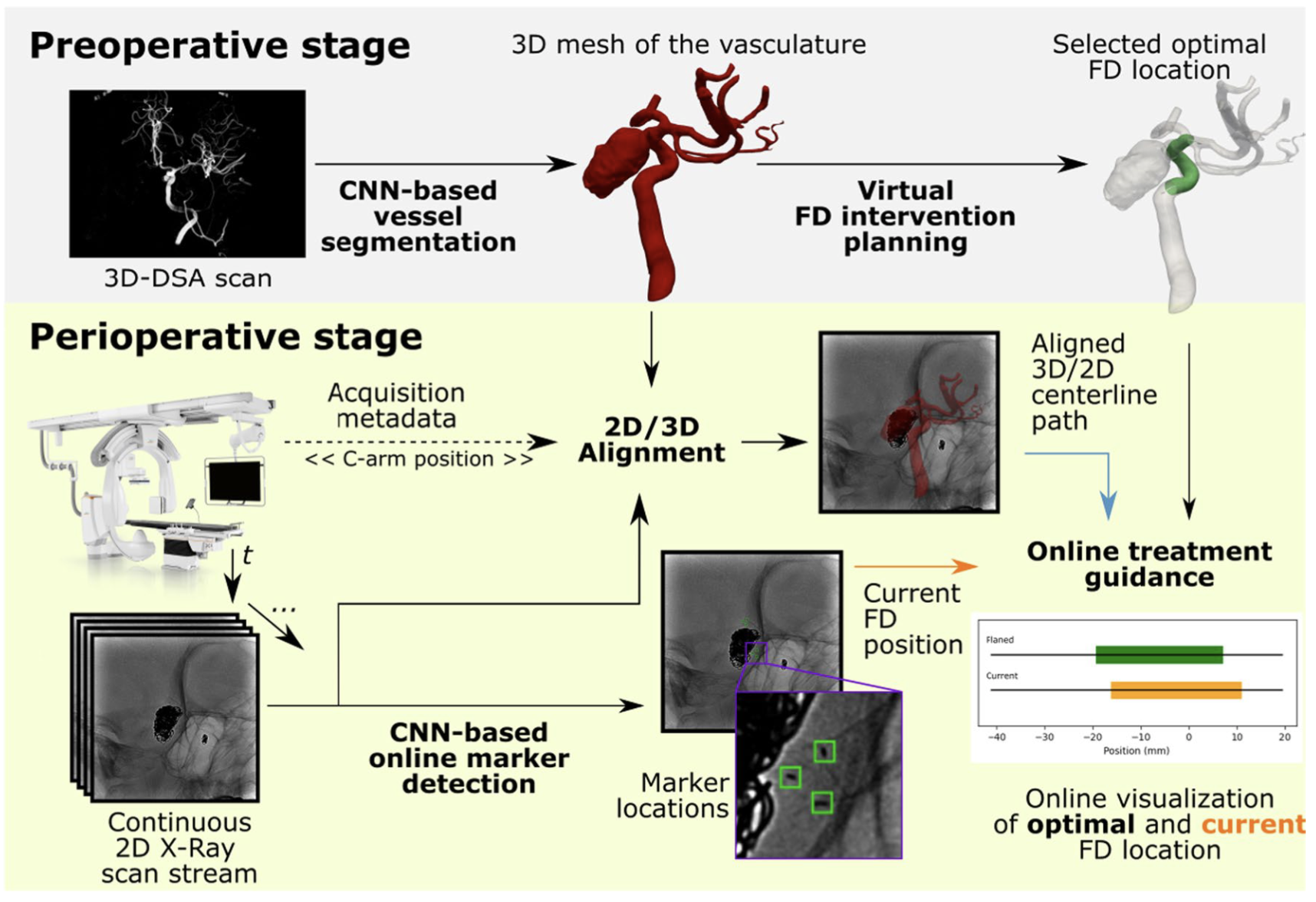 Computer Aided Intracranial Aneurysm Treatment Based on 2D/3D Mapping, Virtual Deployment and ...